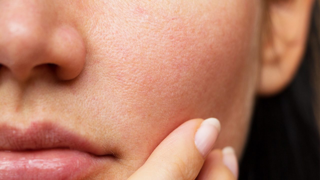 ¿Qué diferencia hay entre eritrosis y cuperosis? - Dermipedia