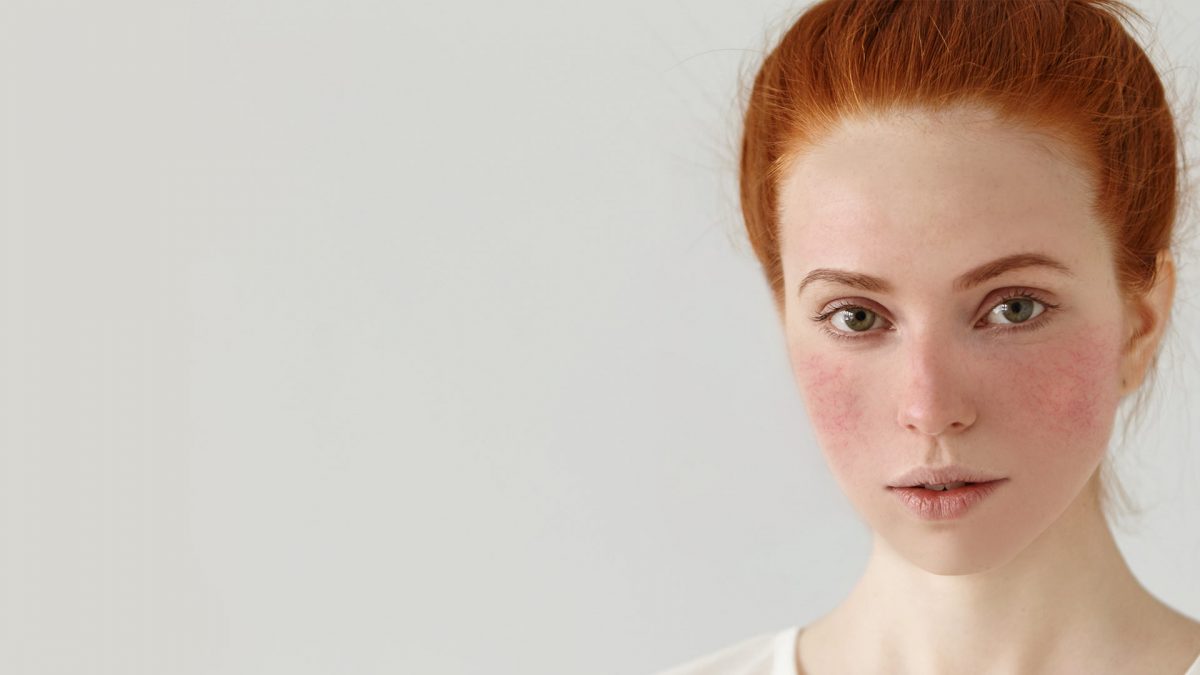 Cómo cuidar de tu eritrosis e intentar disimular su intensidad - Dermipedia