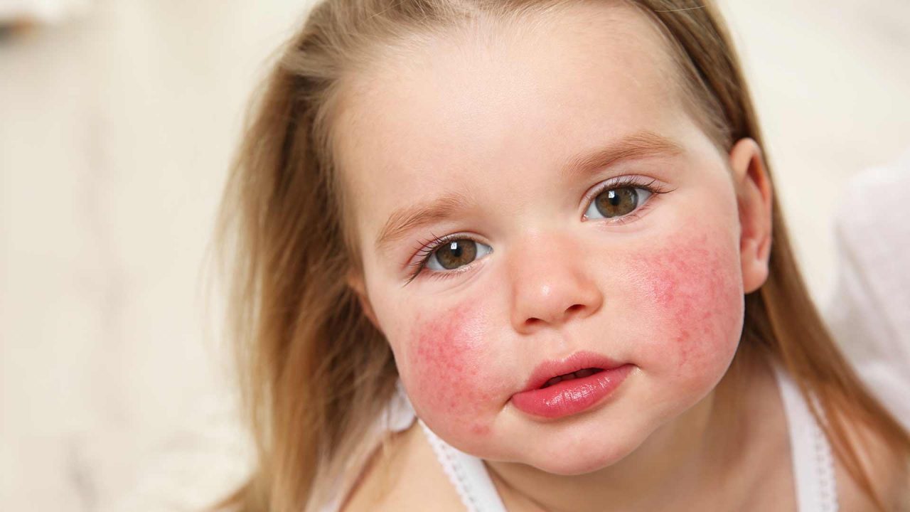 Los tipos de infecciones en la piel más comunes - Dermipedia