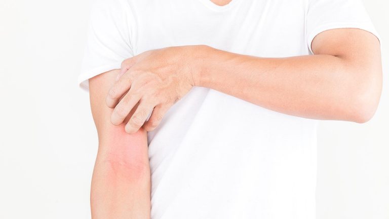 Los tipos de infecciones en la piel más comunes - Dermipedia