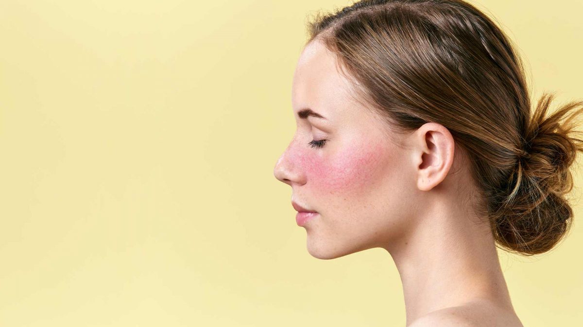 Cómo cuidar de tu eritrosis e intentar disimular su intensidad - Dermipedia